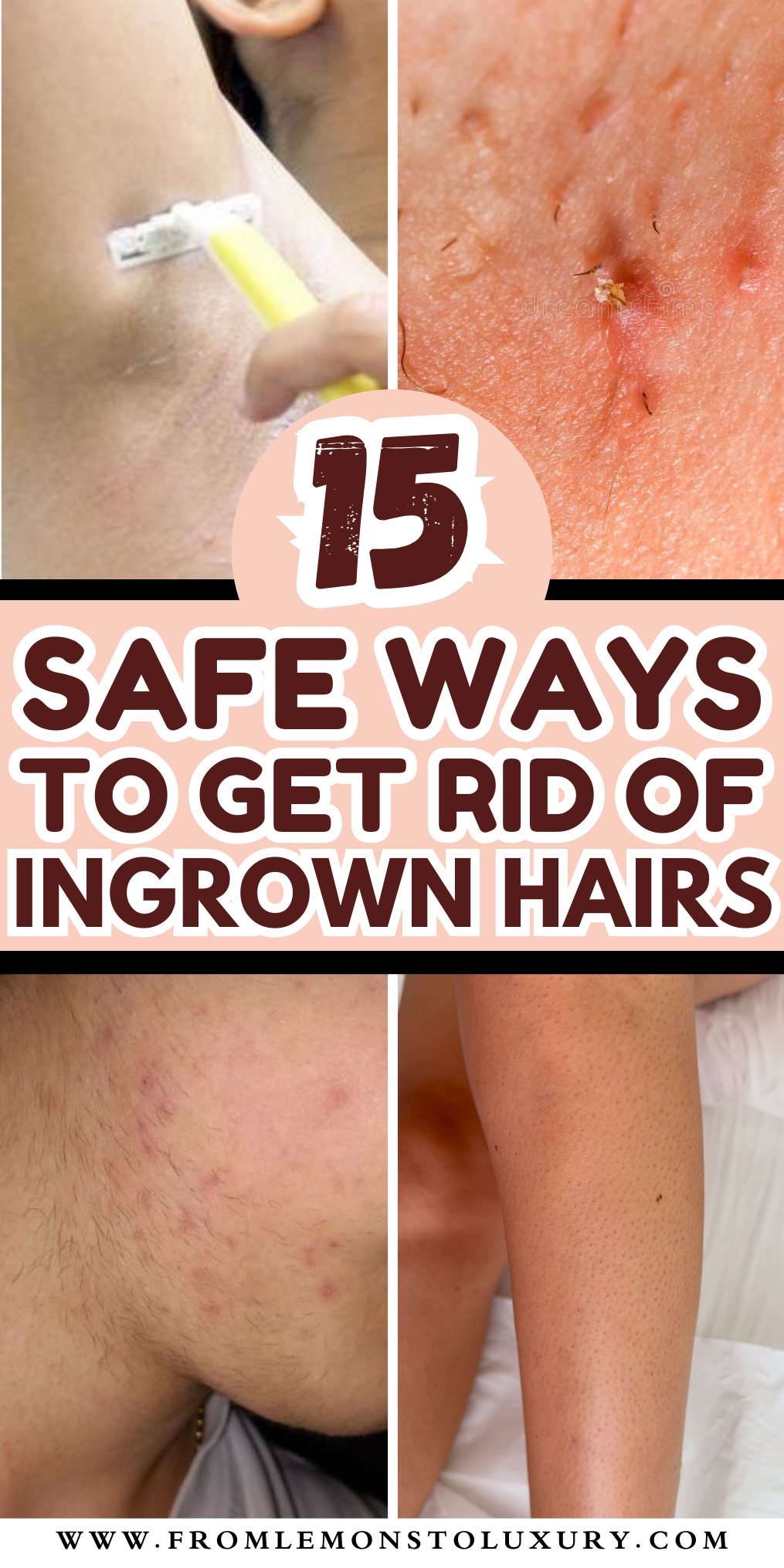 15+ Safe Treatments To Get Rid Of Ingrown Hairs - From Lemons To Luxury